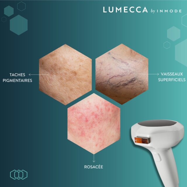 Lumecca IPL Treatment in Celebration, FL | Clear & Radiant Skin