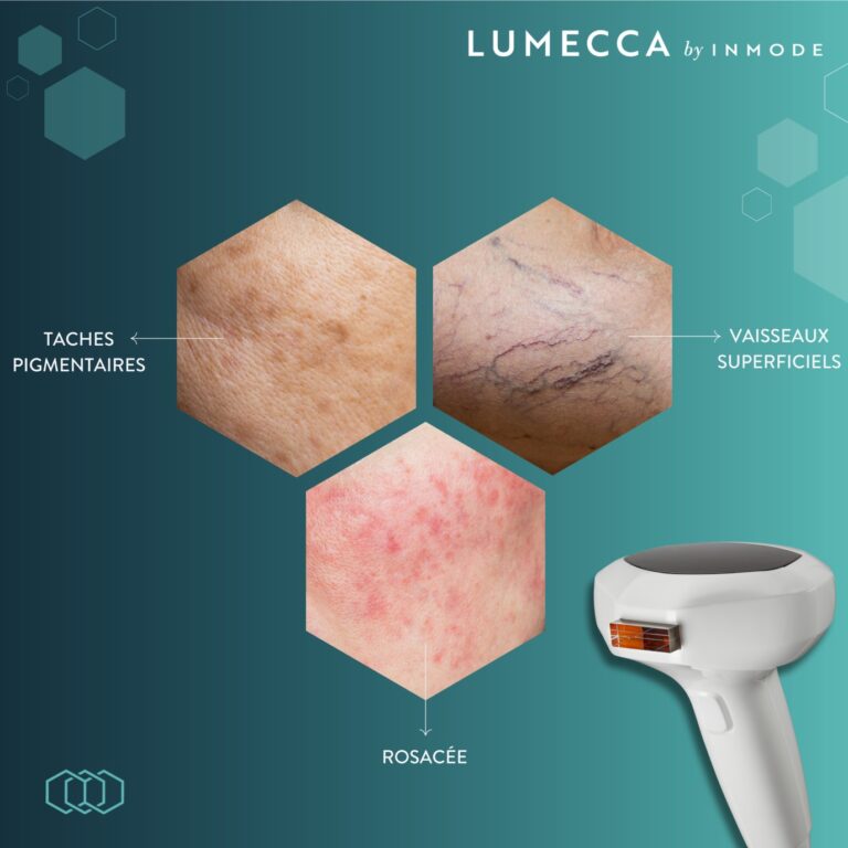 Lumecca IPL Treatment in Celebration, FL | Clear & Radiant Skin